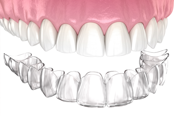 invisalign - Y&B Dental Clinic